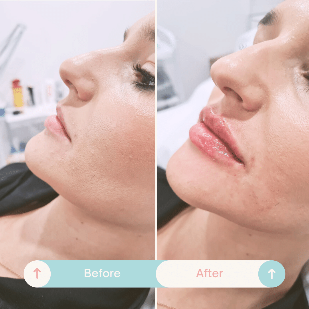 Dermal Fillers - Dr Bianca Le Roux