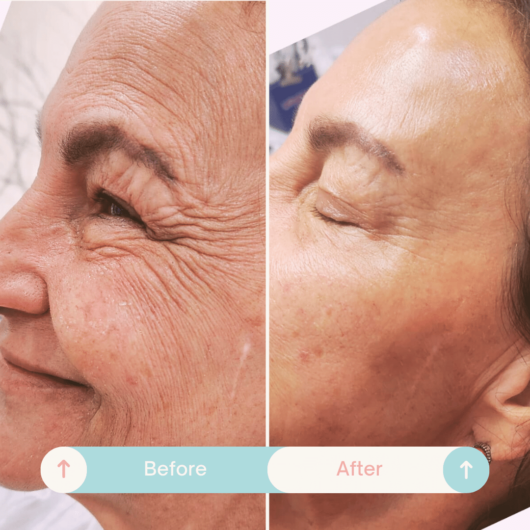 Dermal Fillers - Dr Bianca Le Roux