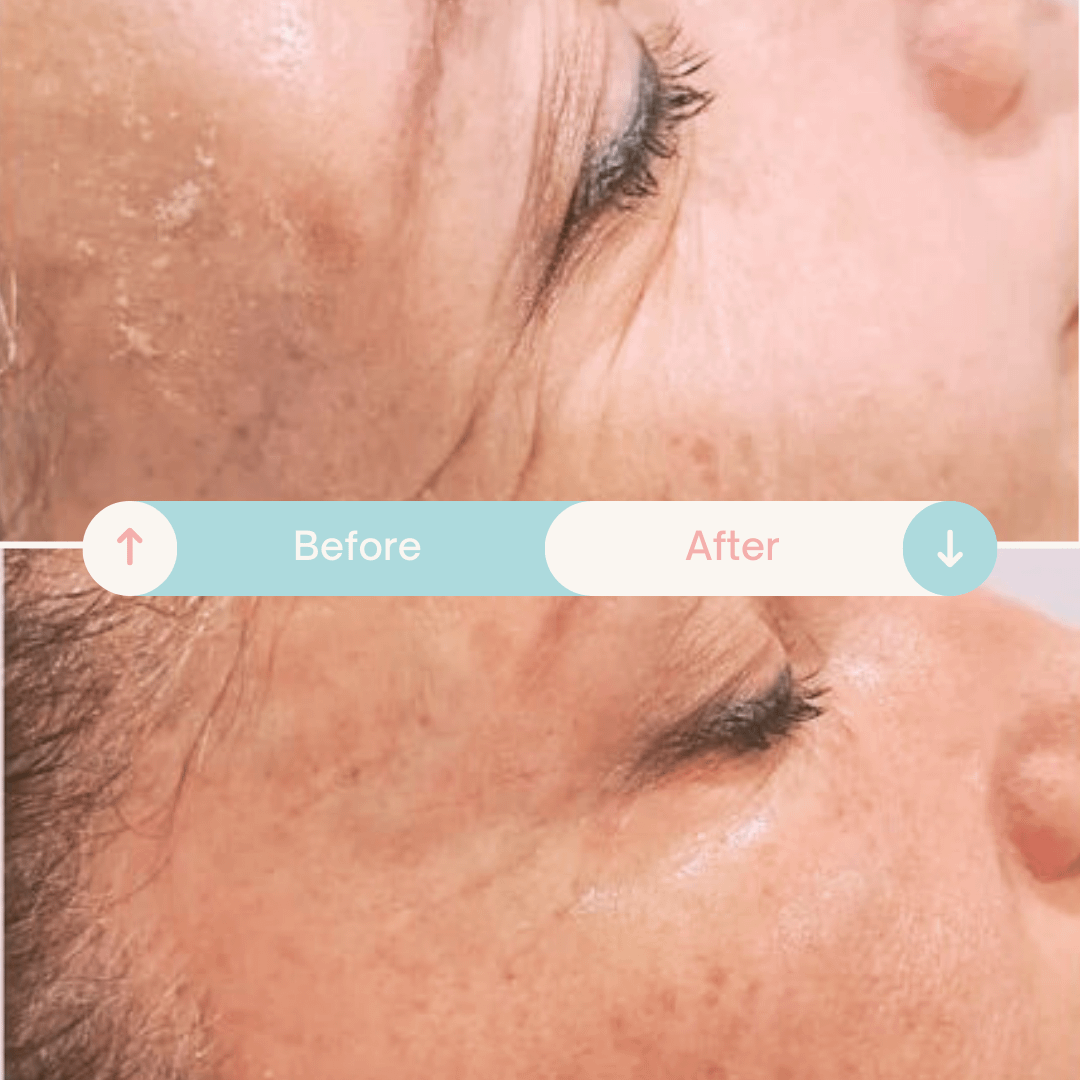 Eye Rejuvenation - Dr Bianca Le Roux